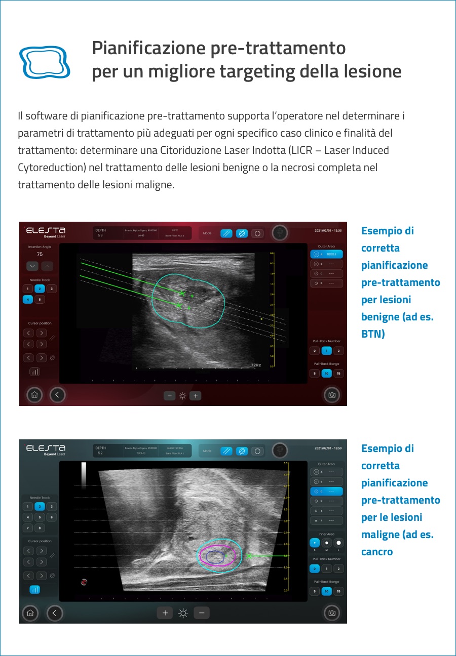 EchoLaser EVO | Elesta Echolaser