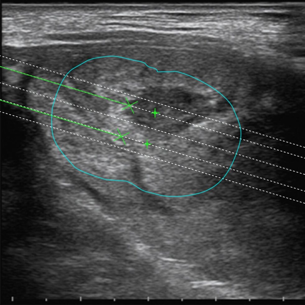 EchoLaser | Elesta Echolaser